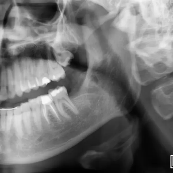 Safe Wisdom Tooth Removal | Expert Care & Quick Recovery